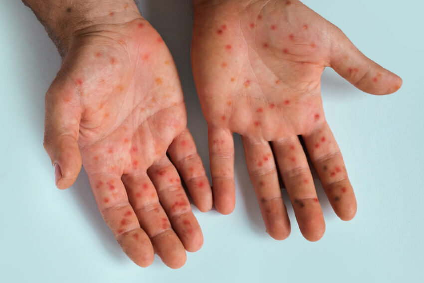 Iloilo City confirms first MPOX case
